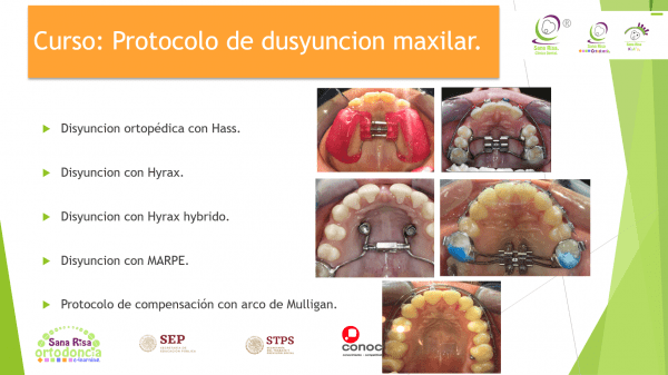Protocolos De Disyunción Maxilar Sana Risa E Learning